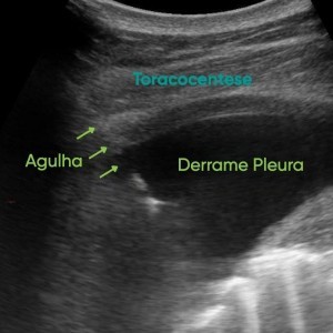 Tudo que Você Precisa Saber Sobre Toracocentese